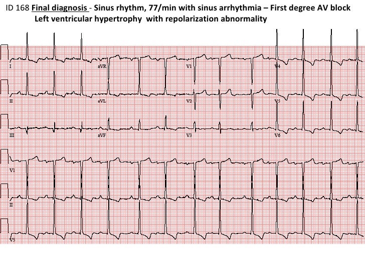 ECG #6 - ID 168 LVH