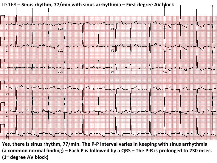 ECG #6 - ID 168 LVH