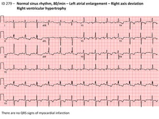 ECG #7 - ID 279 - RVH | PPT
