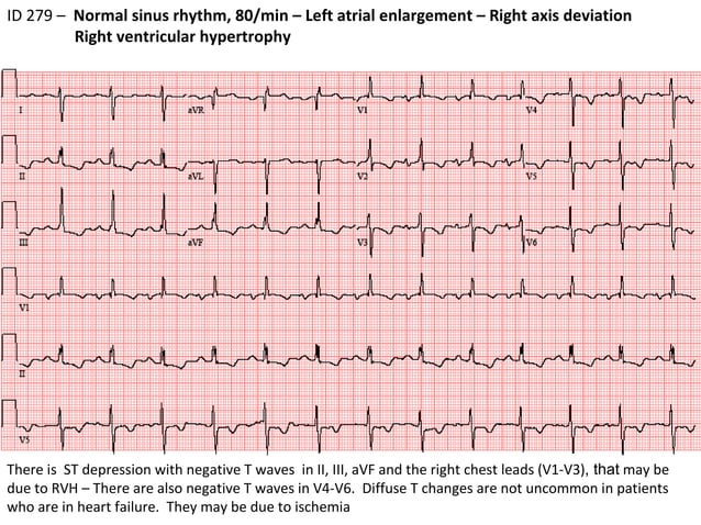 ECG #7 - ID 279 - RVH | PPT