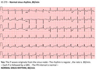 ECG #7 - ID 279 - RVH | PPT