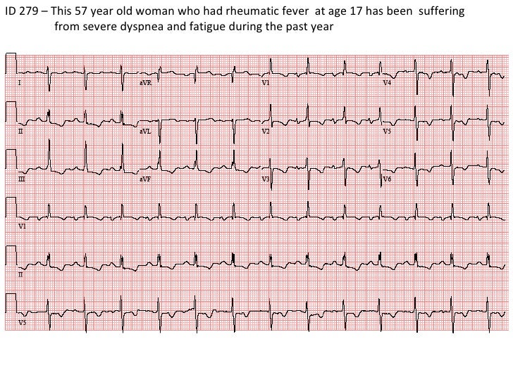 ECG #7 - ID 279 - RVH