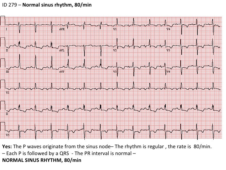 ECG #7 - ID 279 - RVH