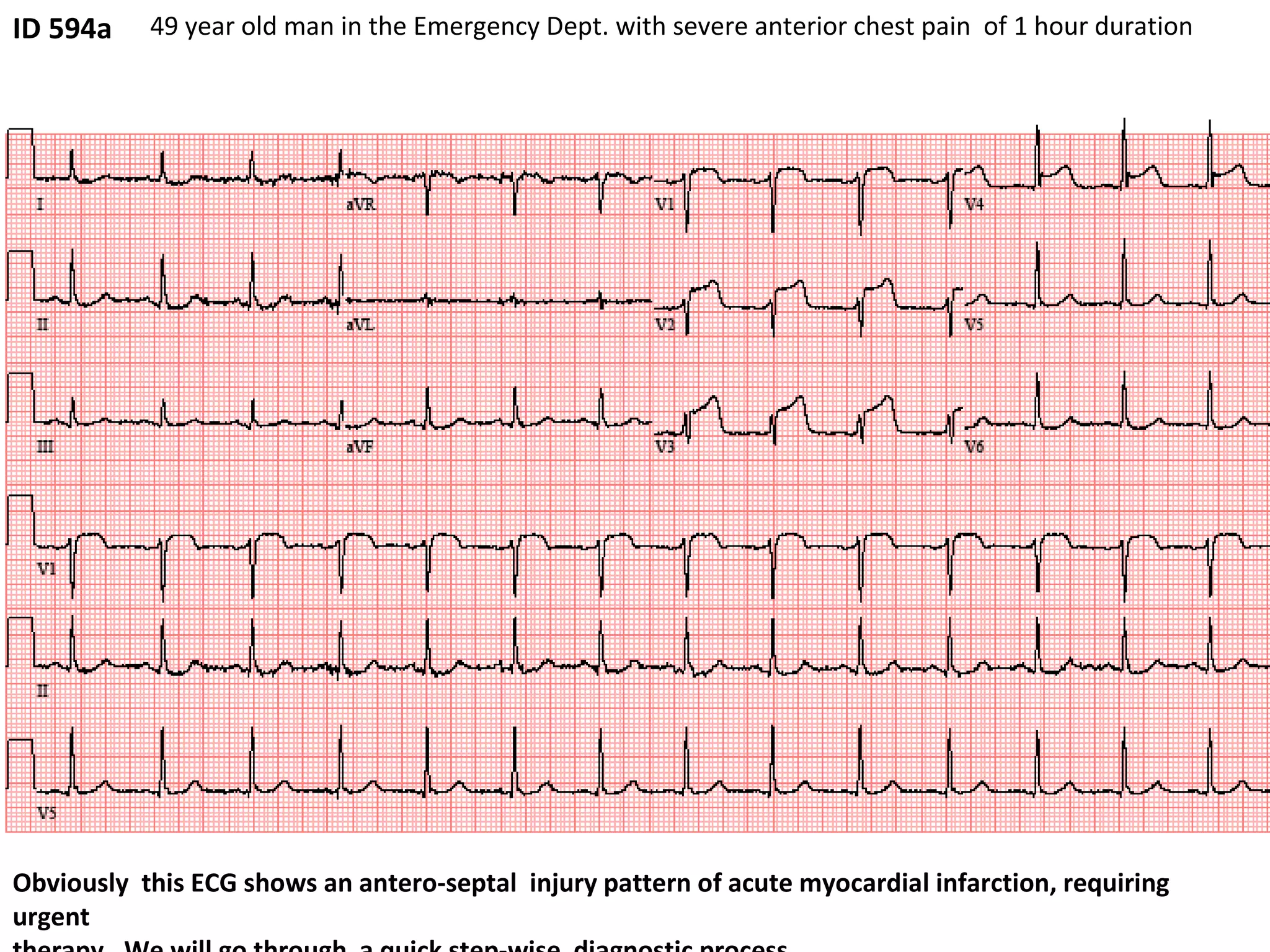 ECG #9 - ID594a - acute ASMI | PPT