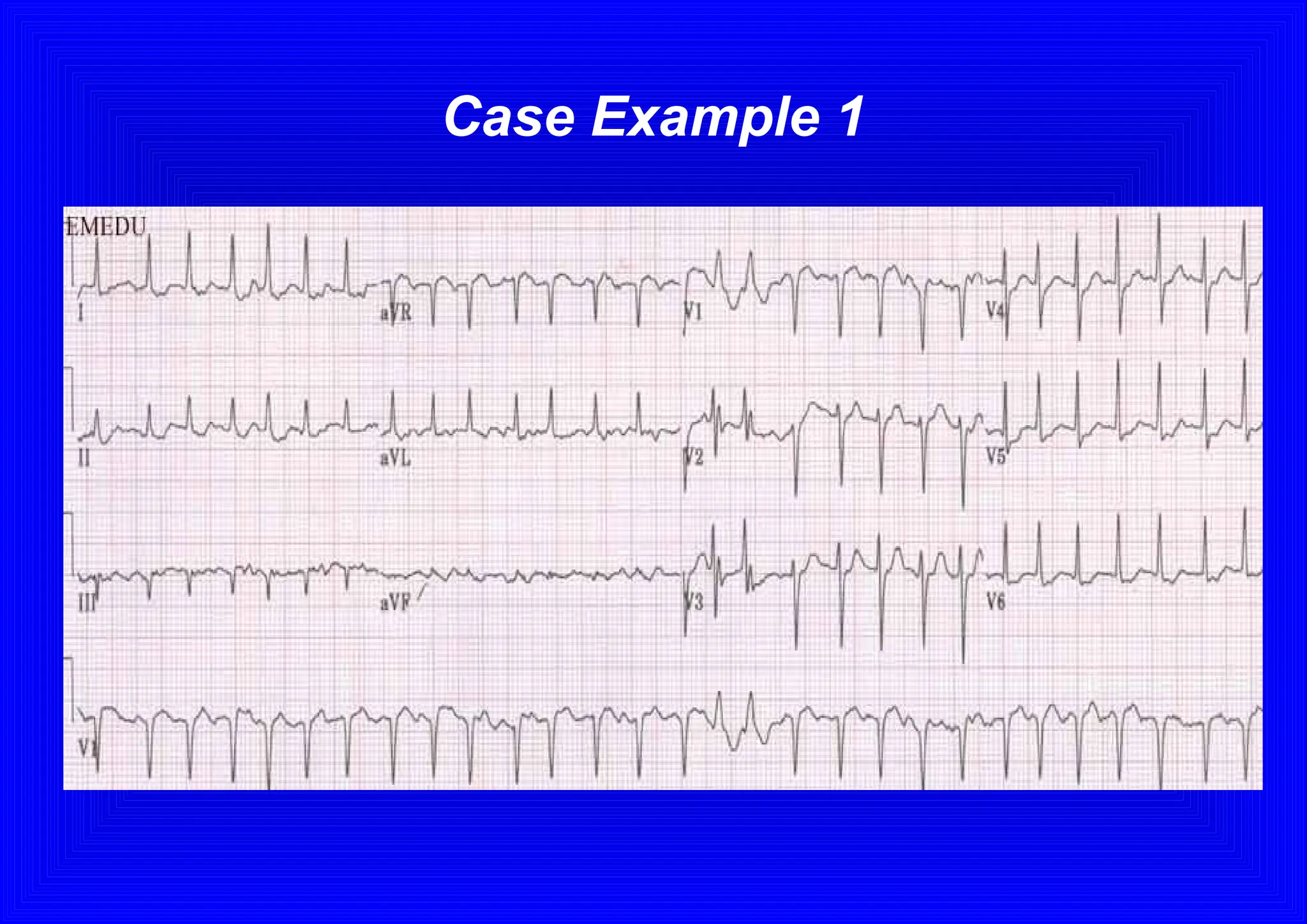ECG-Analysis.ppt interpretation of electrocardiogram | PPT