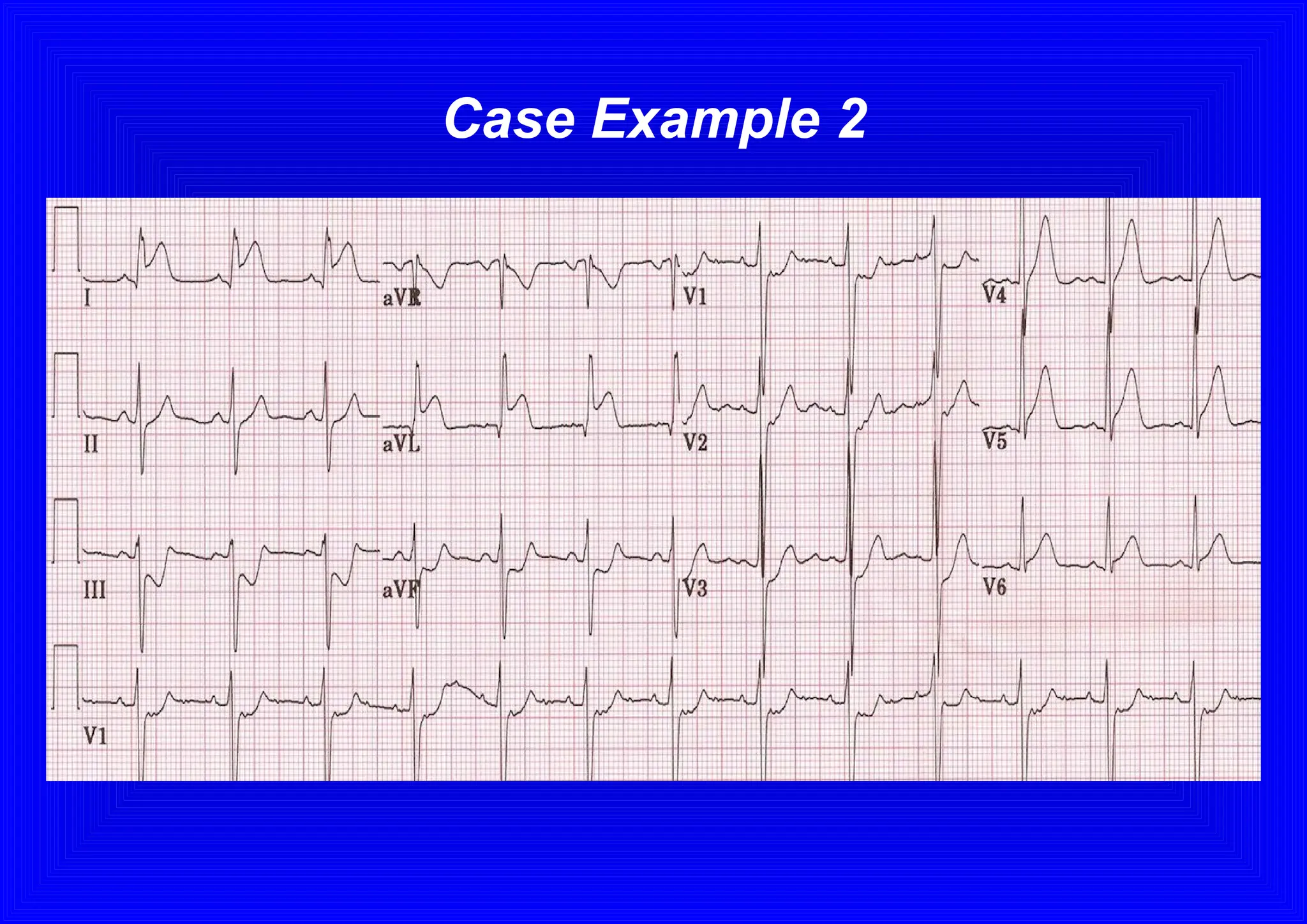 ECG-Analysis.ppt interpretation of electrocardiogram | PPT