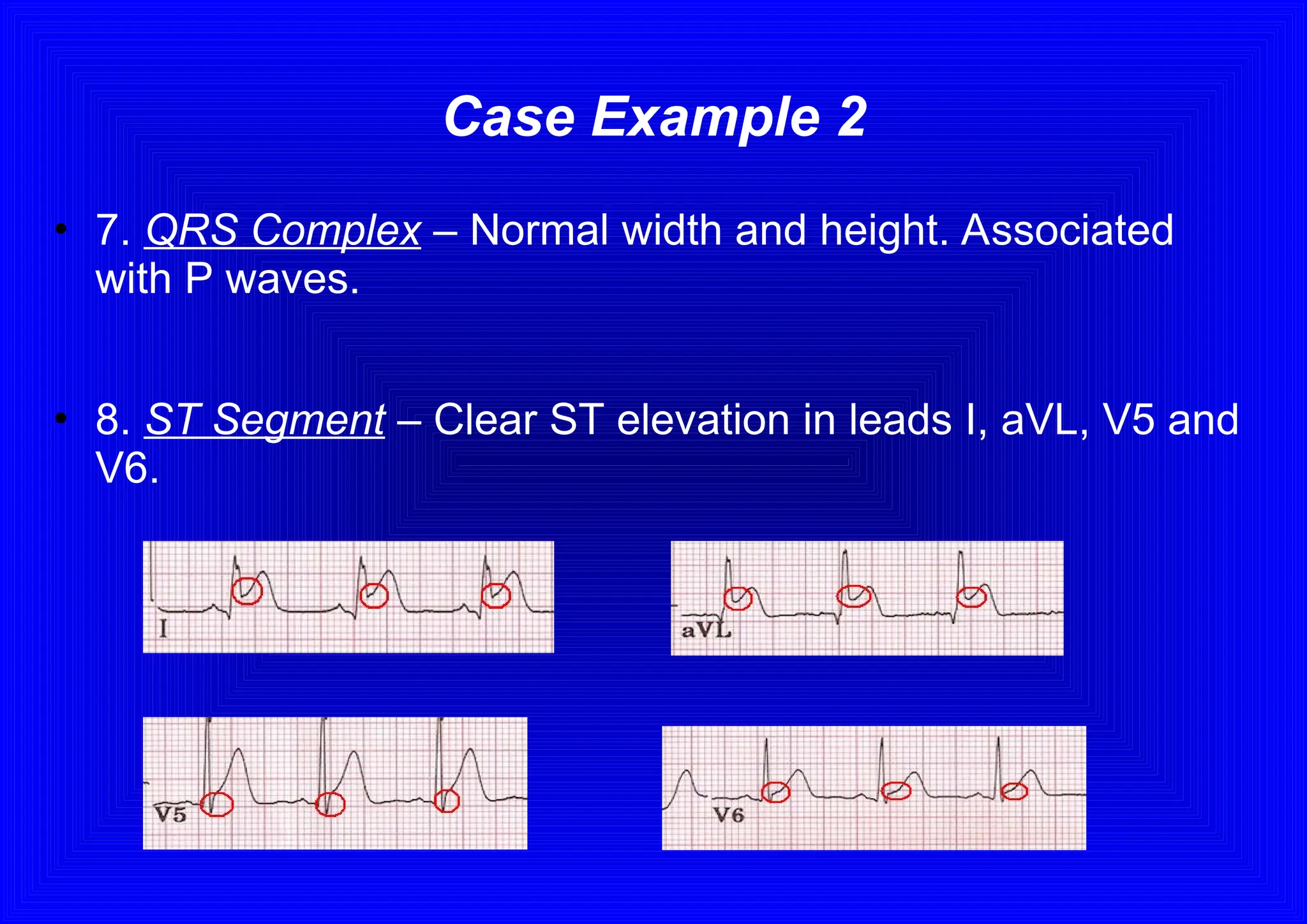 ECG-Analysis.ppt interpretation of electrocardiogram | PPT