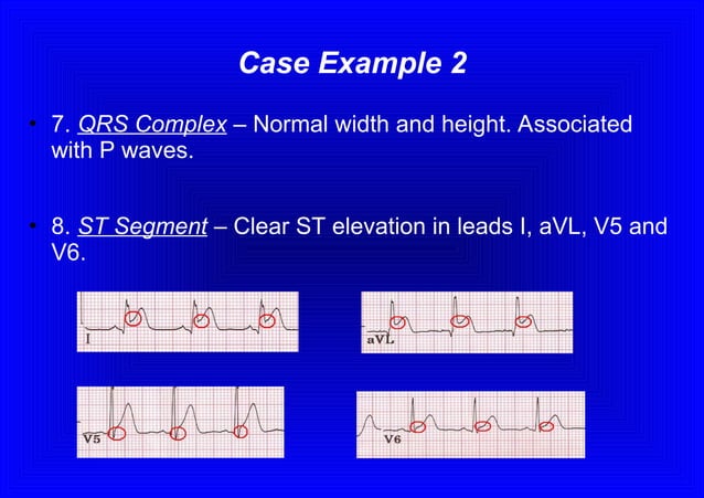ECG-Analysis.ppt interpretation of electrocardiogram | PPT