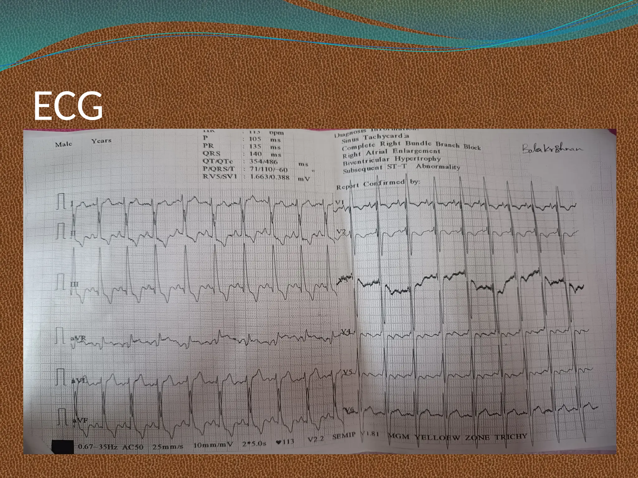 ECG the poor man ANGIOGRAPHY Copy1.pptx