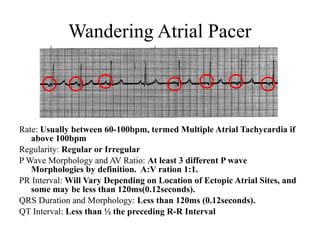 Ecg dysrhythmias-ii | PPT