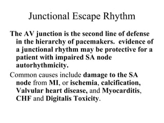 Ecg dysrhythmias-ii | PPT