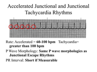 Ecg dysrhythmias-ii | PPT
