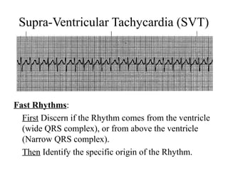 Ecg dysrhythmias-ii | PPT