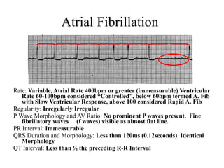 Ecg dysrhythmias-ii | PPT