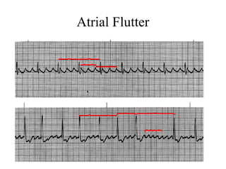Ecg dysrhythmias-ii | PPT