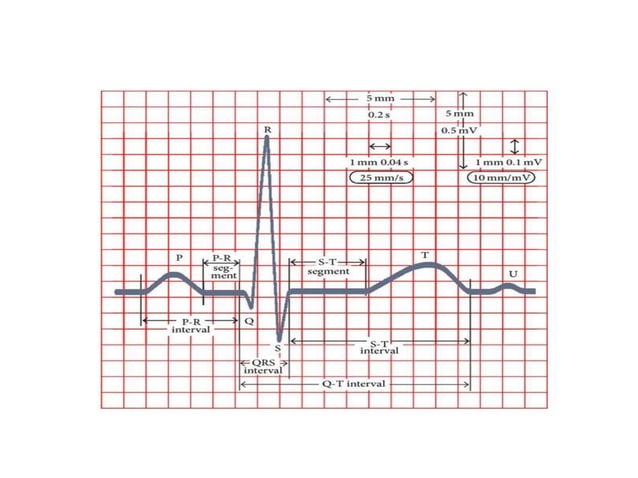 ECG- ELECTROCARDIOGRAM basics and interpretation | PPT