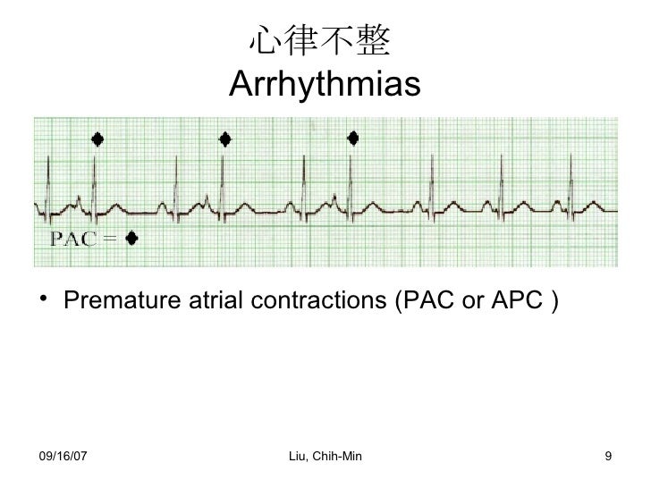 Ecg For Na 20070918