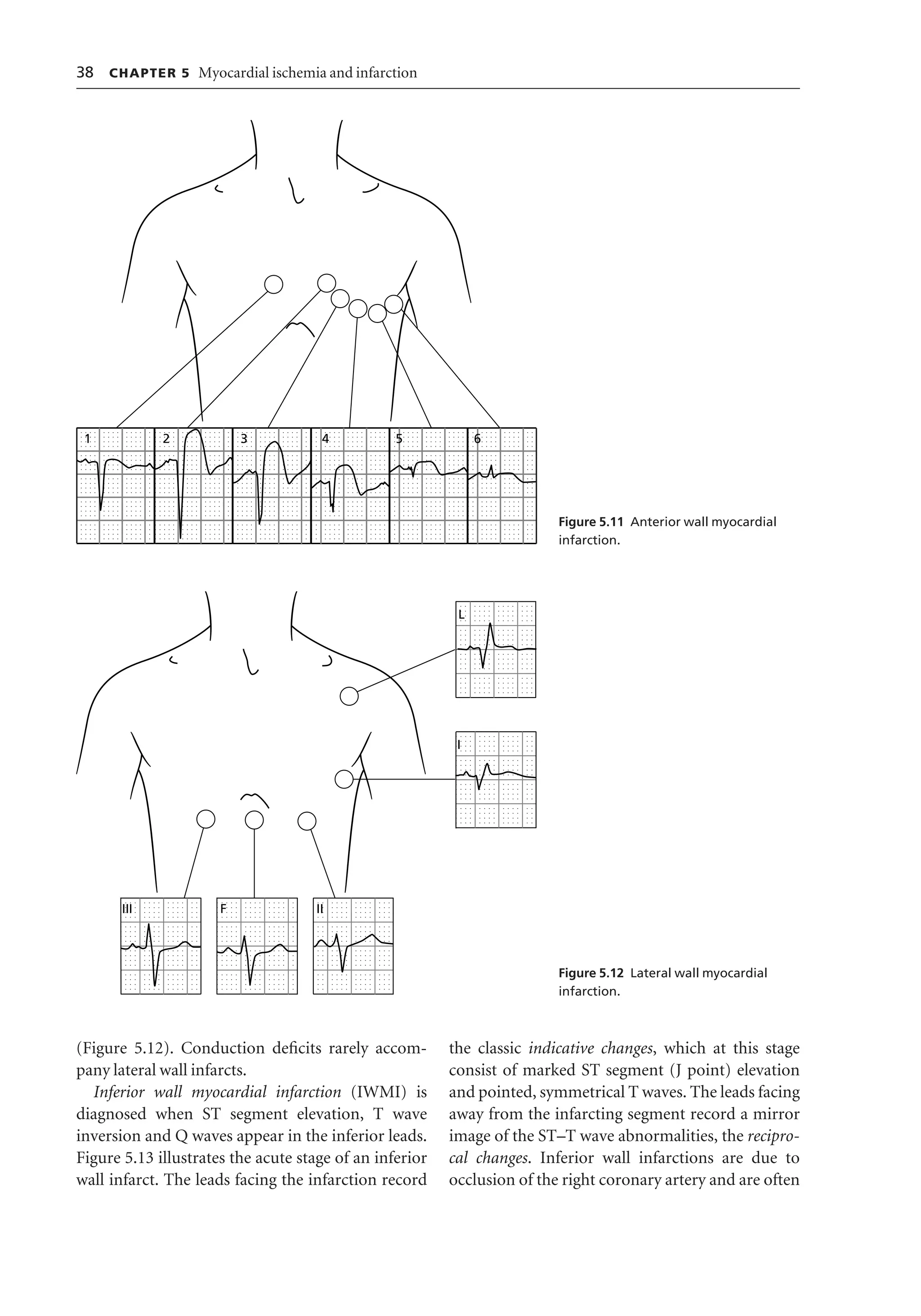 Ecg interpretation | PDF | Heart and Cardiovascular Diseases | Diseases ...