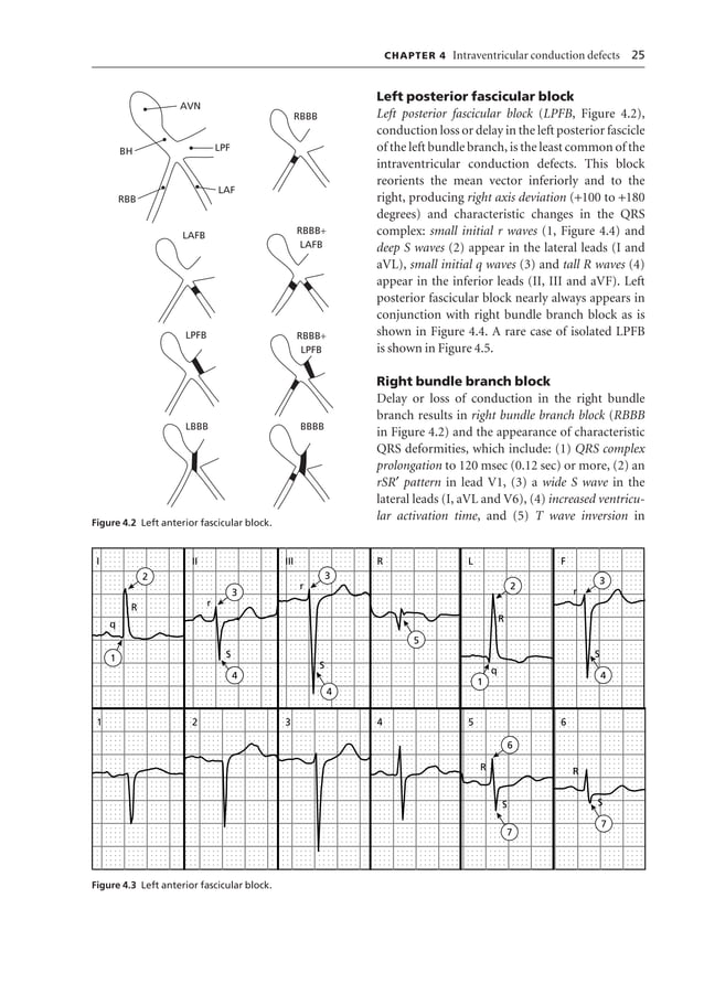 Ecg interpretation | PDF | Heart and Cardiovascular Diseases | Diseases ...