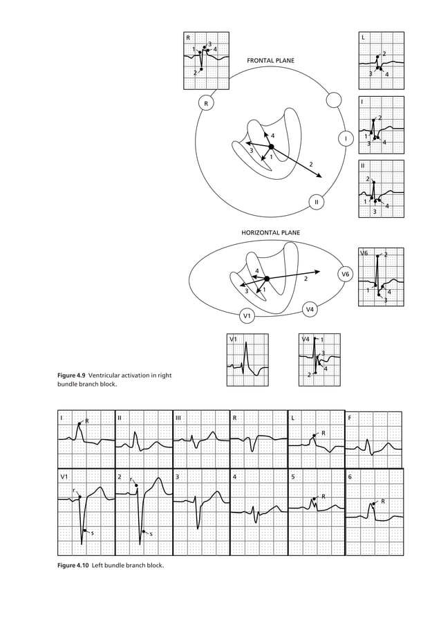 Ecg interpretation | PDF | Heart and Cardiovascular Diseases | Diseases ...