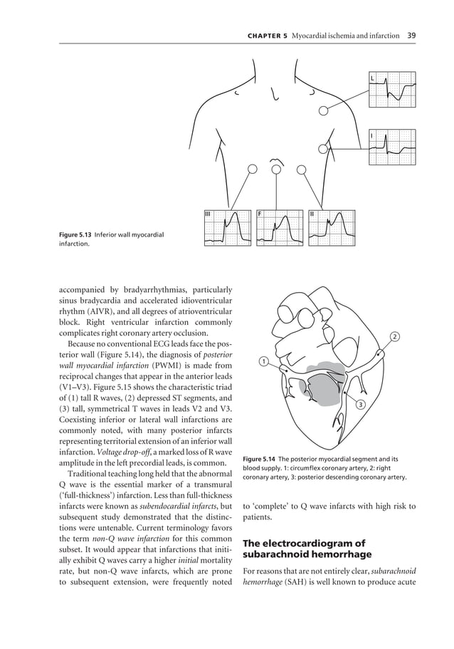 Ecg interpretation | PDF | Heart and Cardiovascular Diseases | Diseases ...