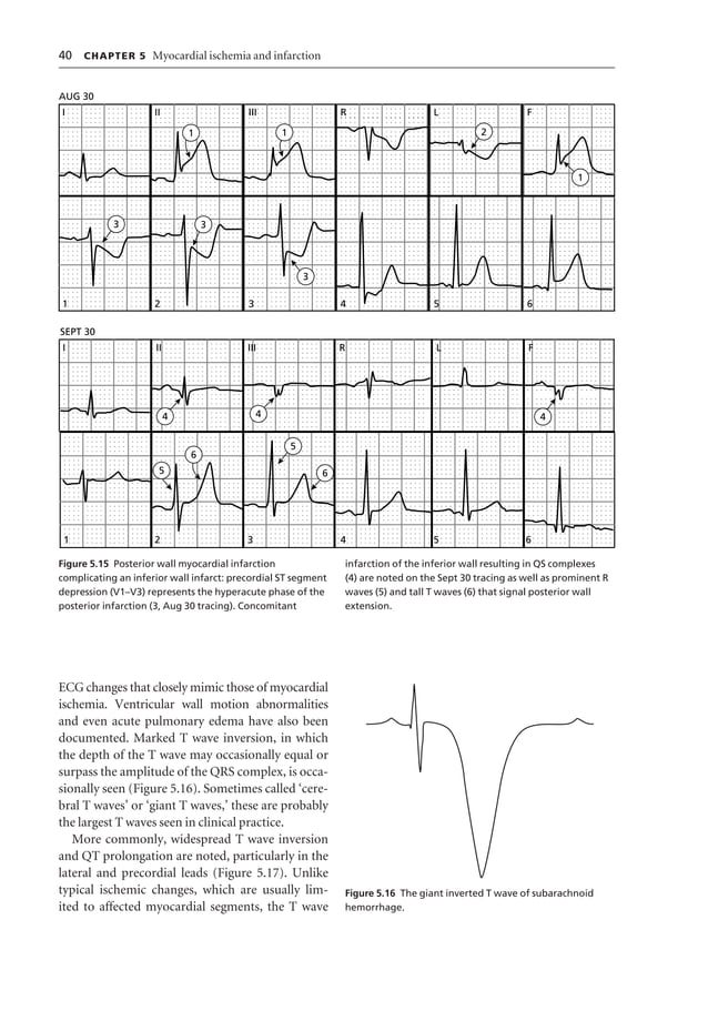 Ecg interpretation | PDF | Heart and Cardiovascular Diseases | Diseases ...