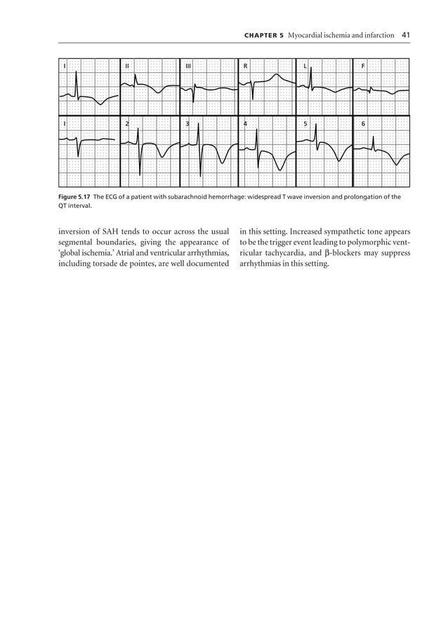 Ecg interpretation | PDF | Heart and Cardiovascular Diseases | Diseases ...