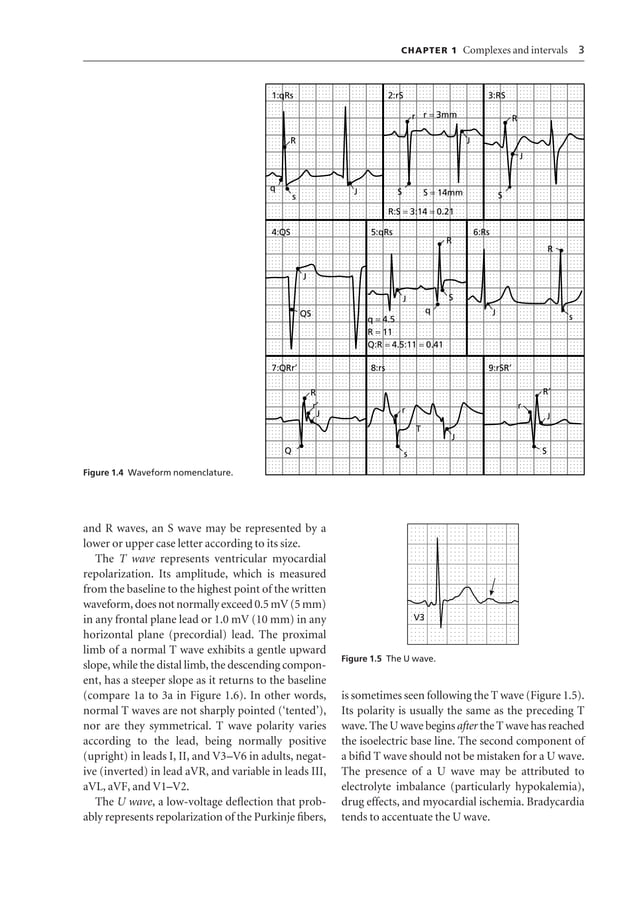 Ecg interpretation | PDF | Heart and Cardiovascular Diseases | Diseases ...