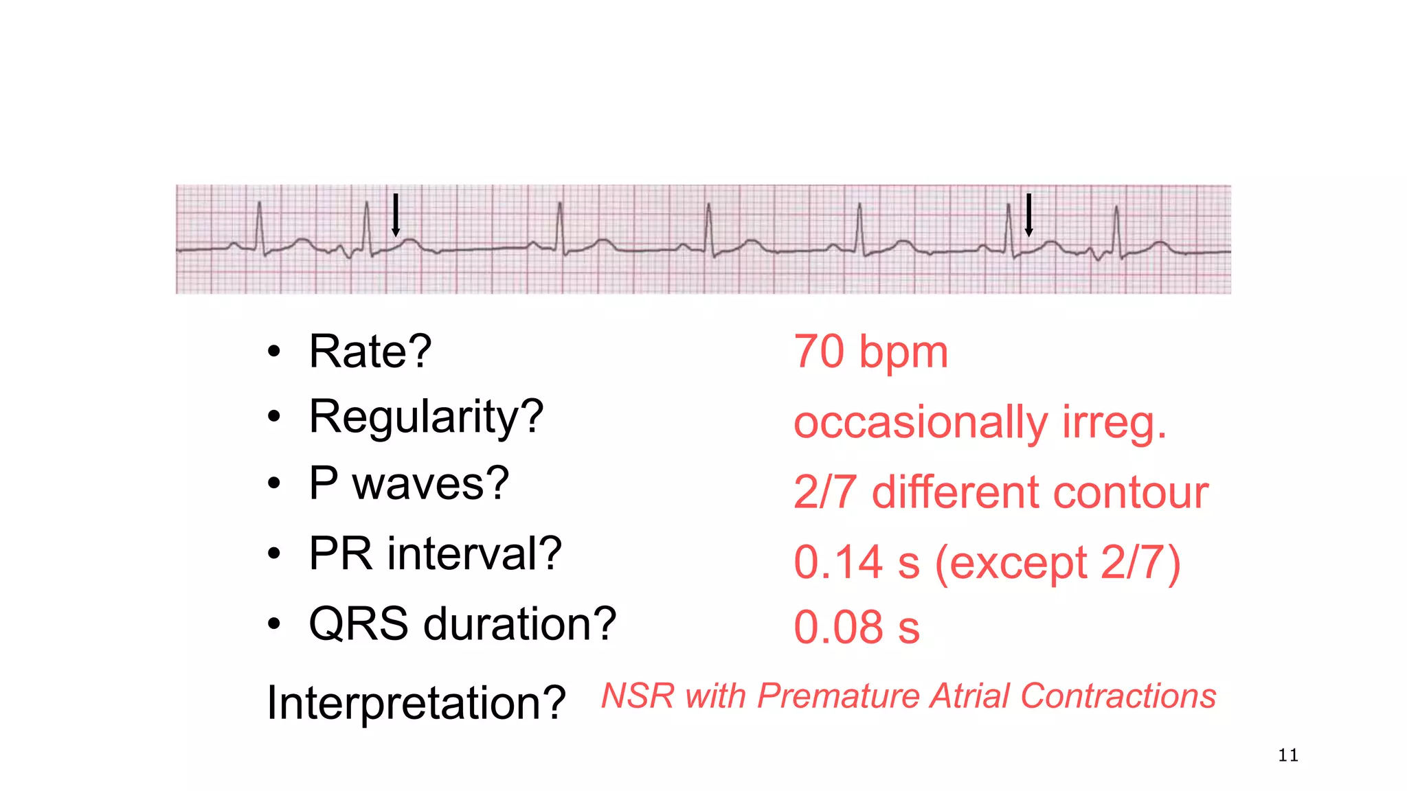 ECG-Interpretation-ppt-for-student.pptx