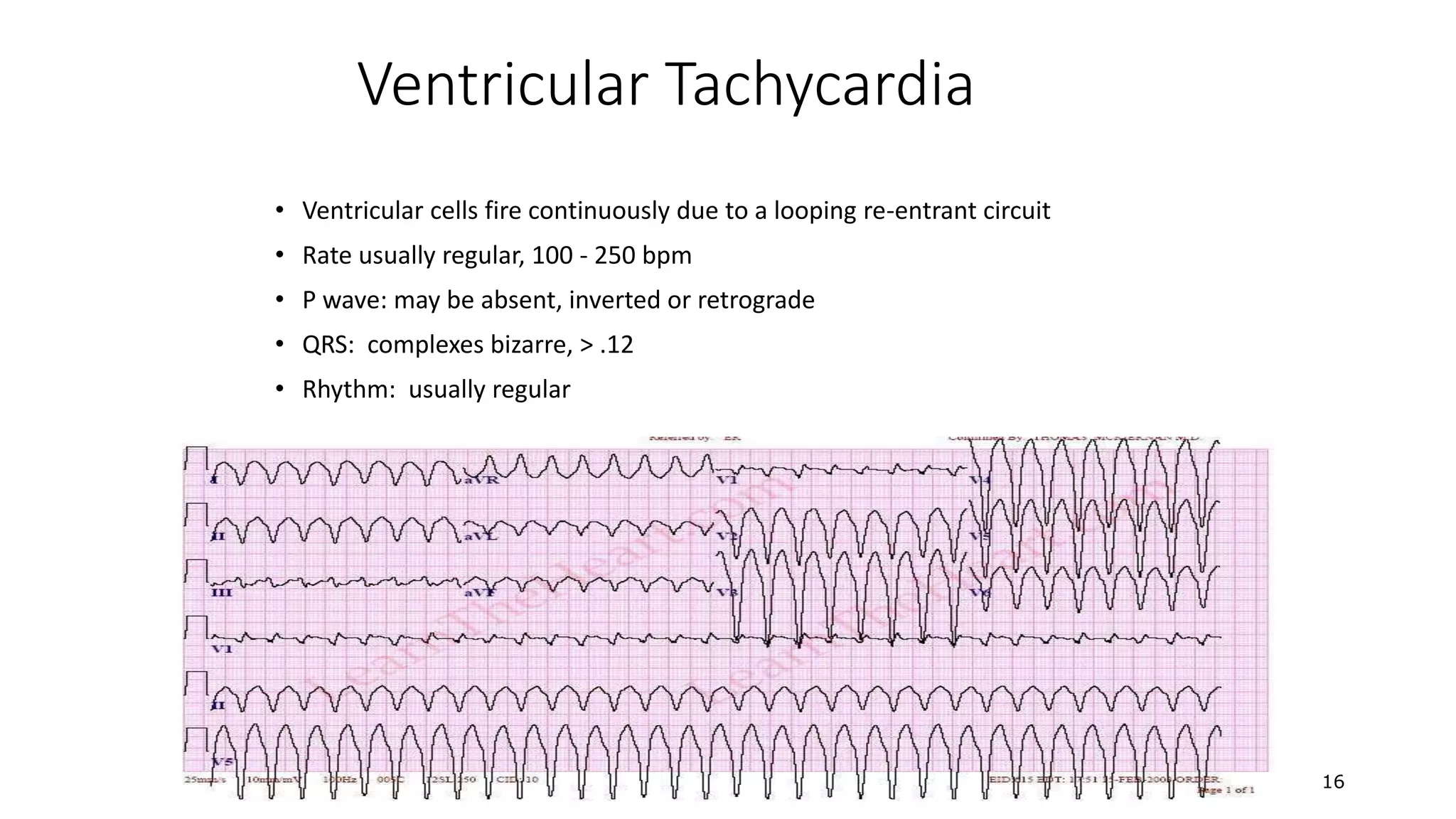 ECG-Interpretation-ppt-for-student.pptx