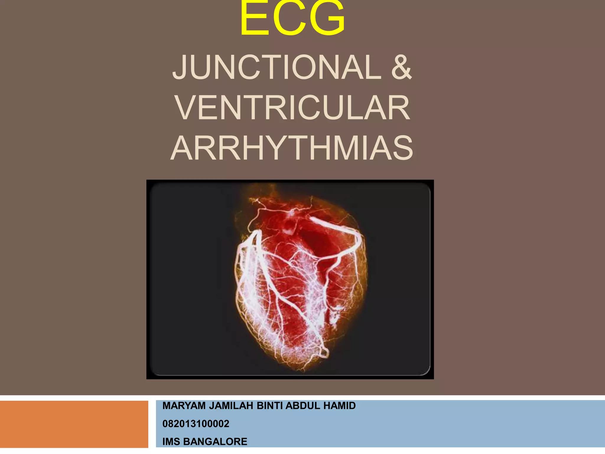 ECG - Junctional Arrhythmia & Ventricular Arrhythmia | PPTX