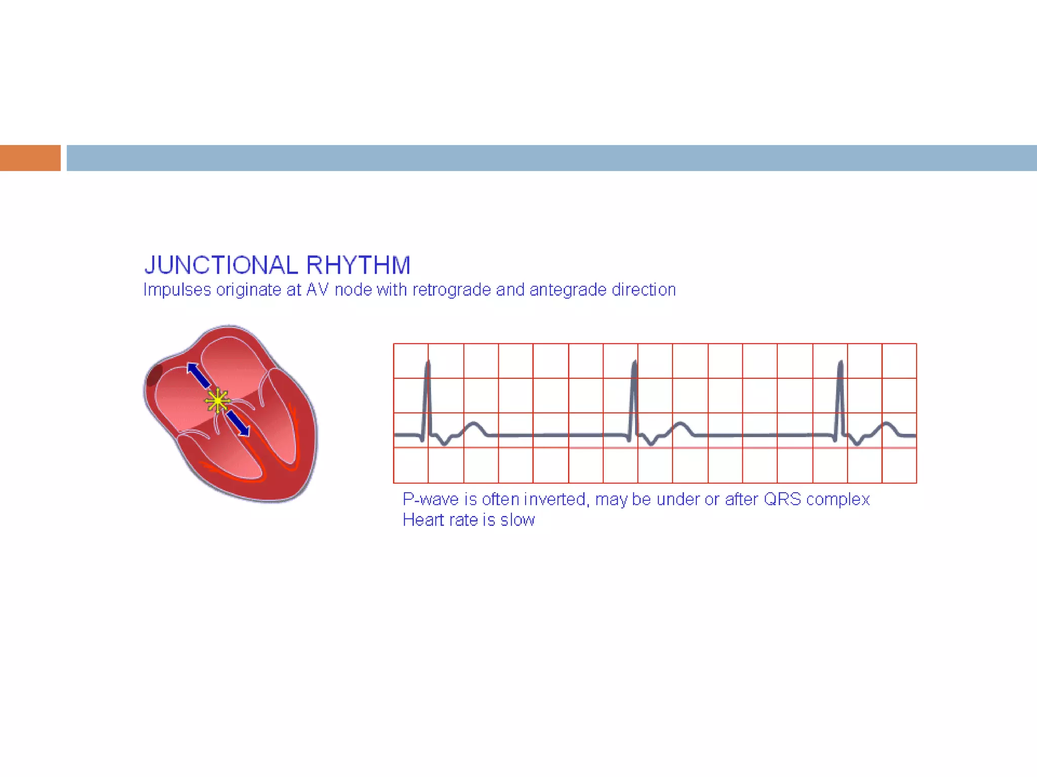 ECG - Junctional Arrhythmia & Ventricular Arrhythmia | PPTX