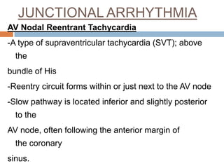 ECG - Junctional Arrhythmia & Ventricular Arrhythmia | PPTX