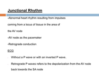 ECG - Junctional Arrhythmia & Ventricular Arrhythmia | PPTX
