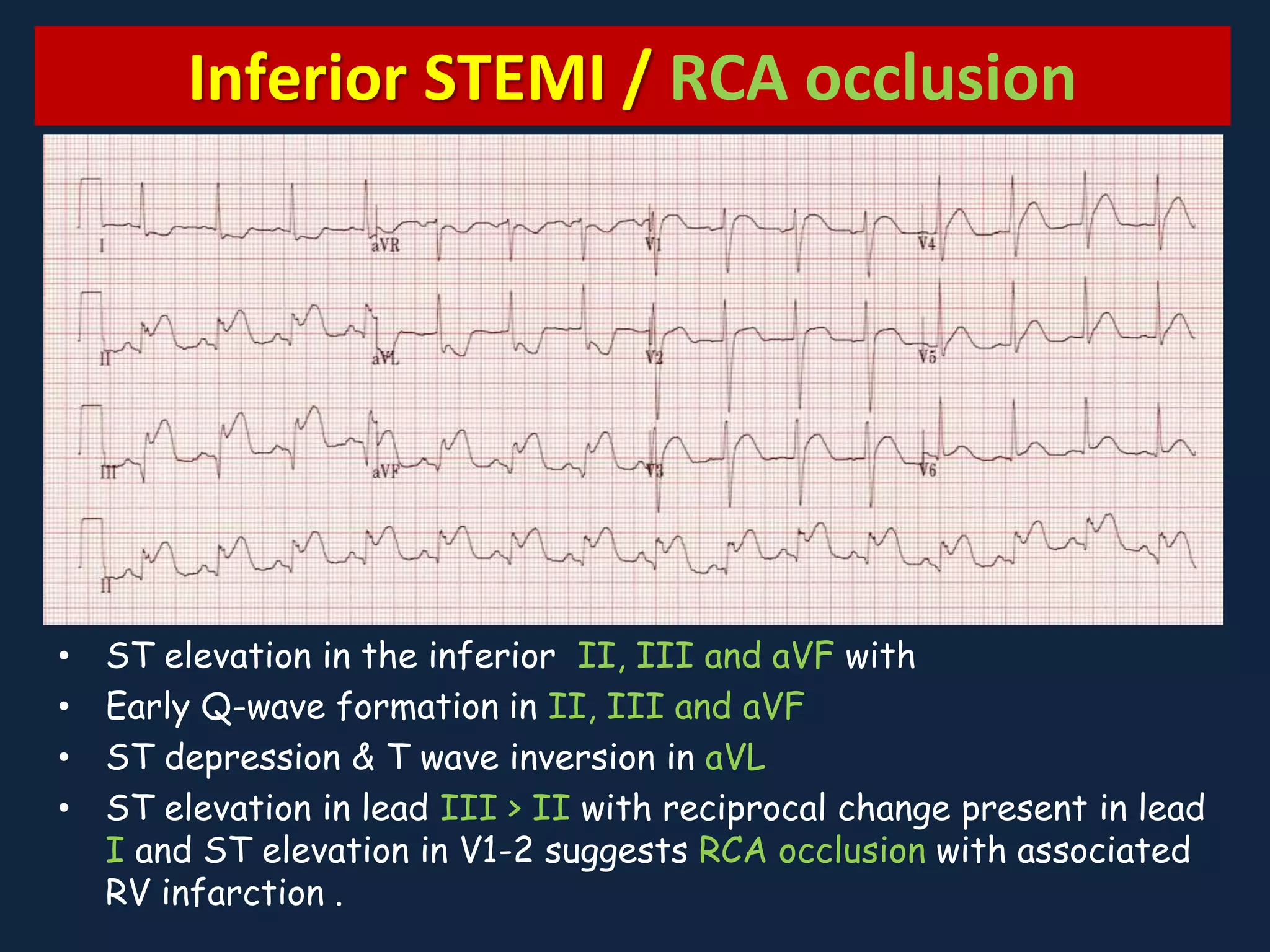 Myocardial Ischemia and Infarction | PPTX