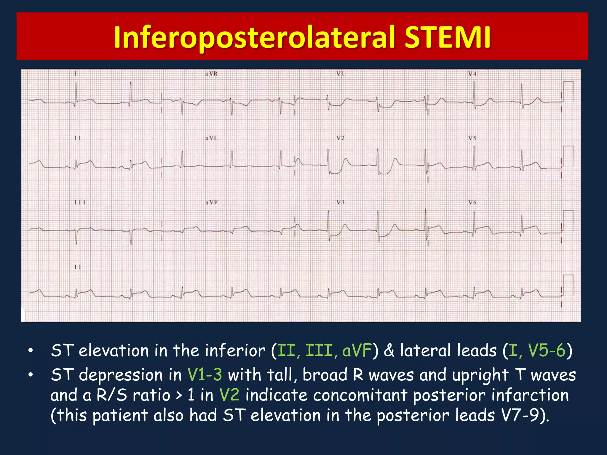 Myocardial Ischemia and Infarction | PPTX