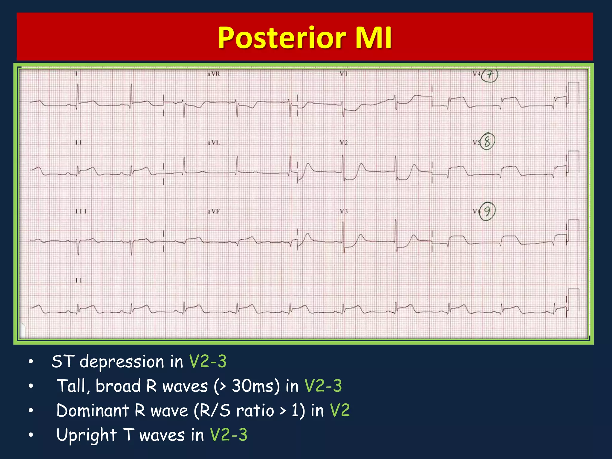 Myocardial Ischemia and Infarction | PPTX