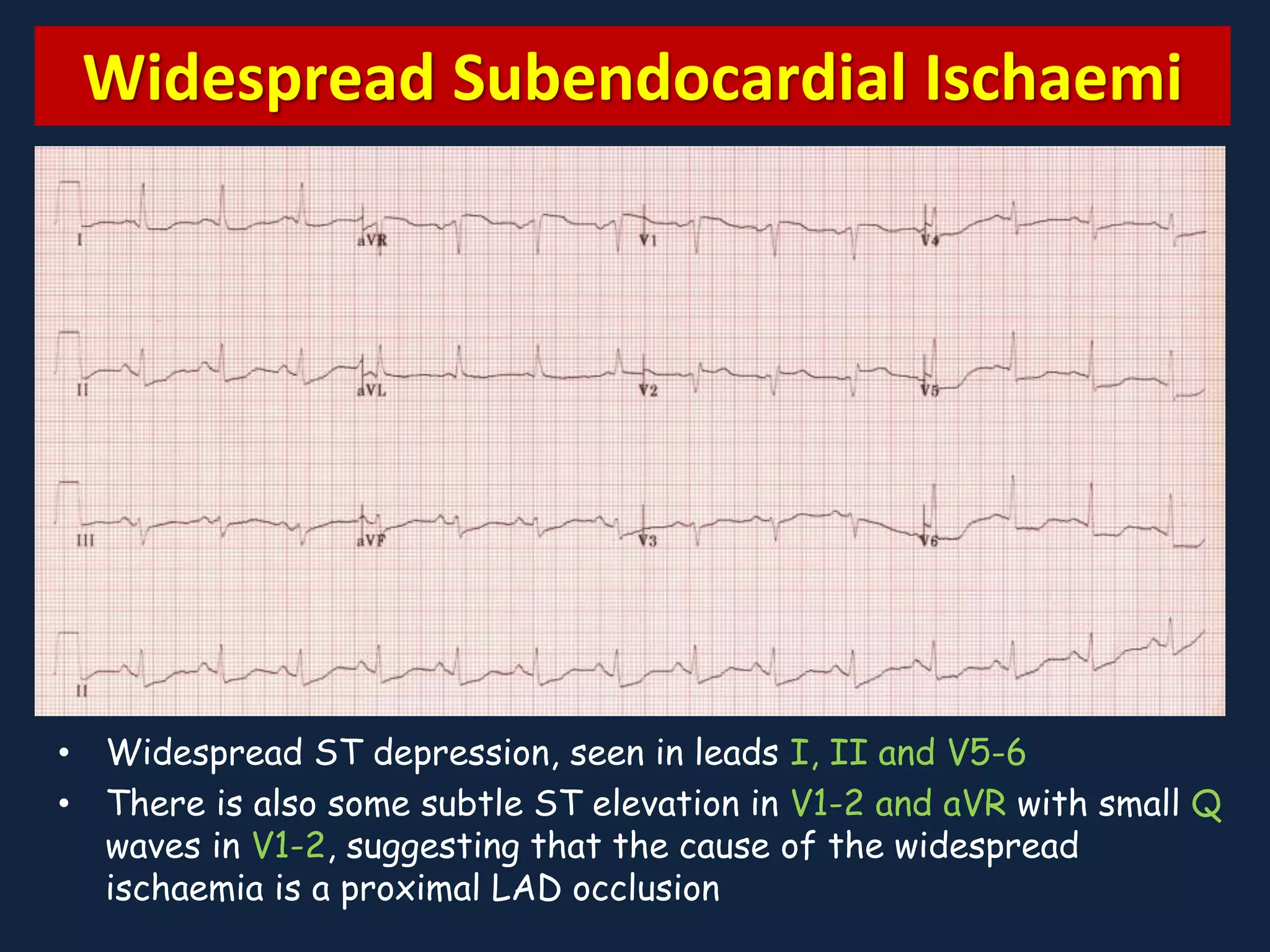Myocardial Ischemia and Infarction | PPTX