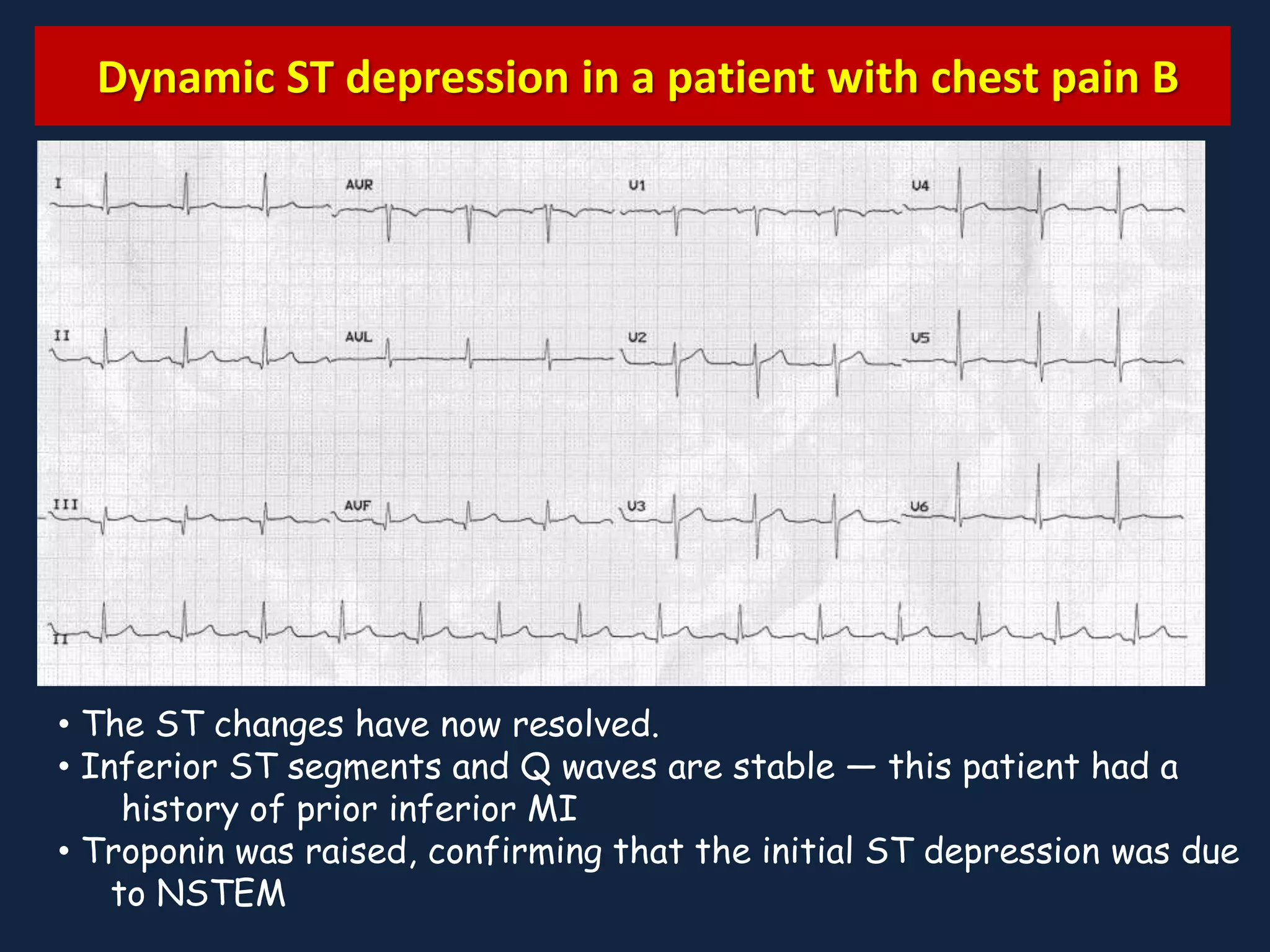 Myocardial Ischemia and Infarction | PPTX