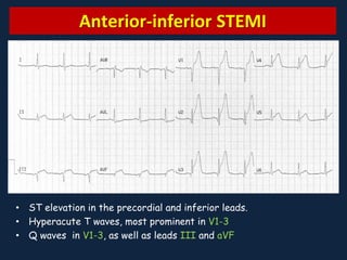Myocardial Ischemia and Infarction | PPTX
