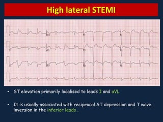 Myocardial Ischemia and Infarction | PPTX