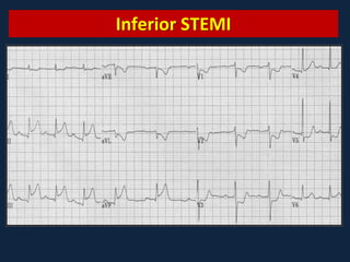 Myocardial Ischemia and Infarction | PPTX