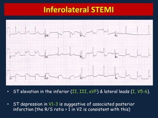 Myocardial Ischemia and Infarction | PPTX