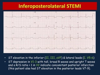 Myocardial Ischemia and Infarction | PPTX