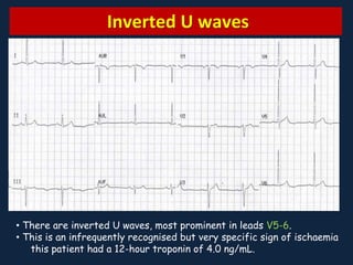 Myocardial Ischemia and Infarction | PPTX
