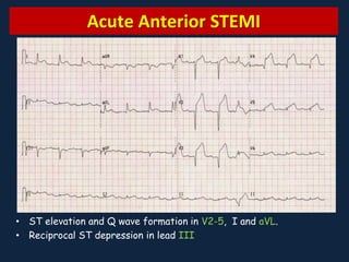 Myocardial Ischemia and Infarction | PPTX
