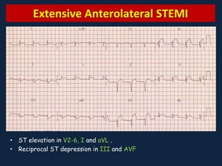 Myocardial Ischemia and Infarction | PPTX