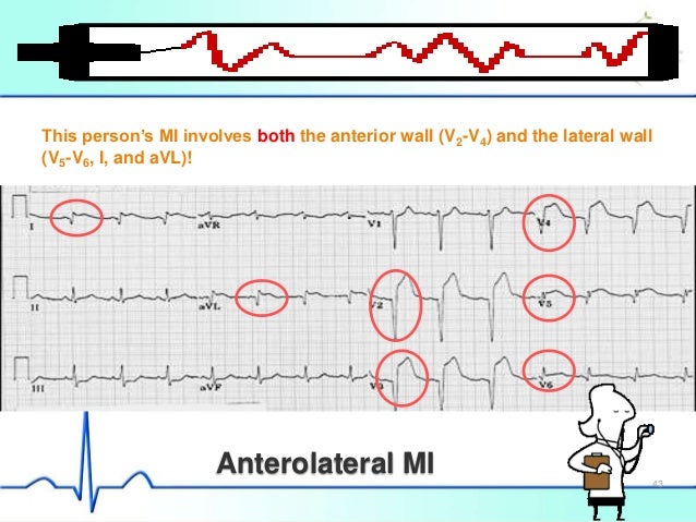 Ecg