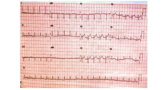 ECG-REVISION final yr physiotherapy .pptx