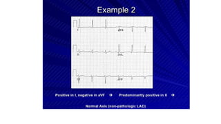 ECG-REVISION final yr physiotherapy .pptx